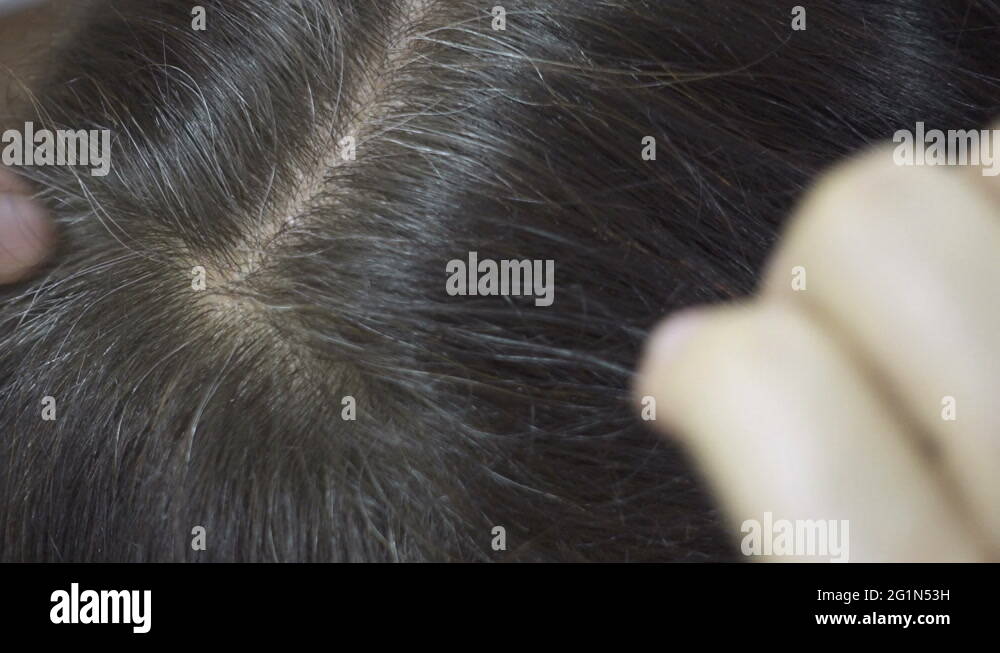 Female head with grey hair close up. Woman showing dandruff and gray ...