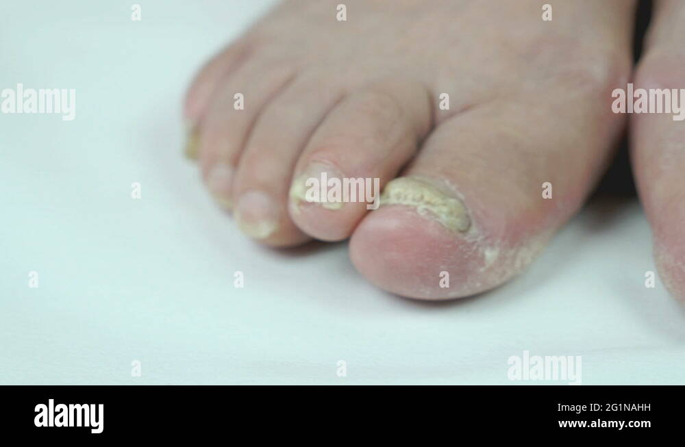 Onychomycosis. Fungal infection of toenails Stock Video Footage - Alamy