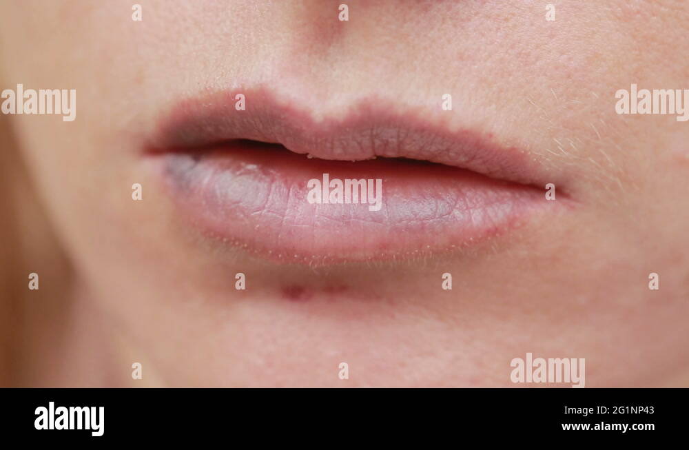 female lips with bruise. close-up. effects of hyaluronic acid. lip ...