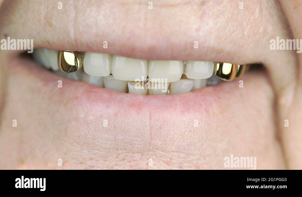 False teeth with gold Stock Videos & Footage - HD and 4K Video Clips ...