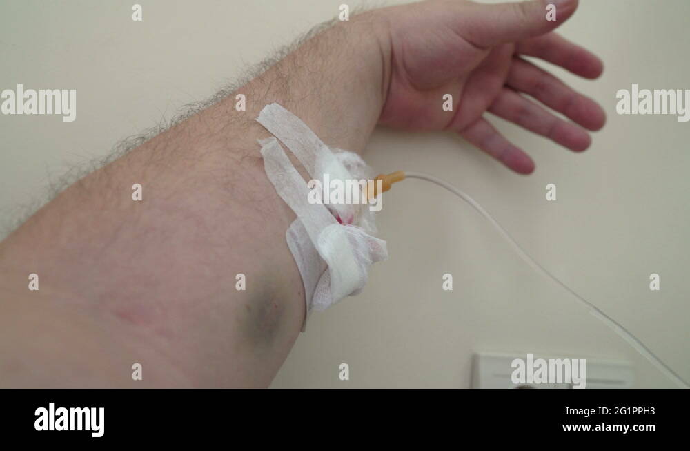 Bruise on the arm of a patient following intravenous injection Stock ...