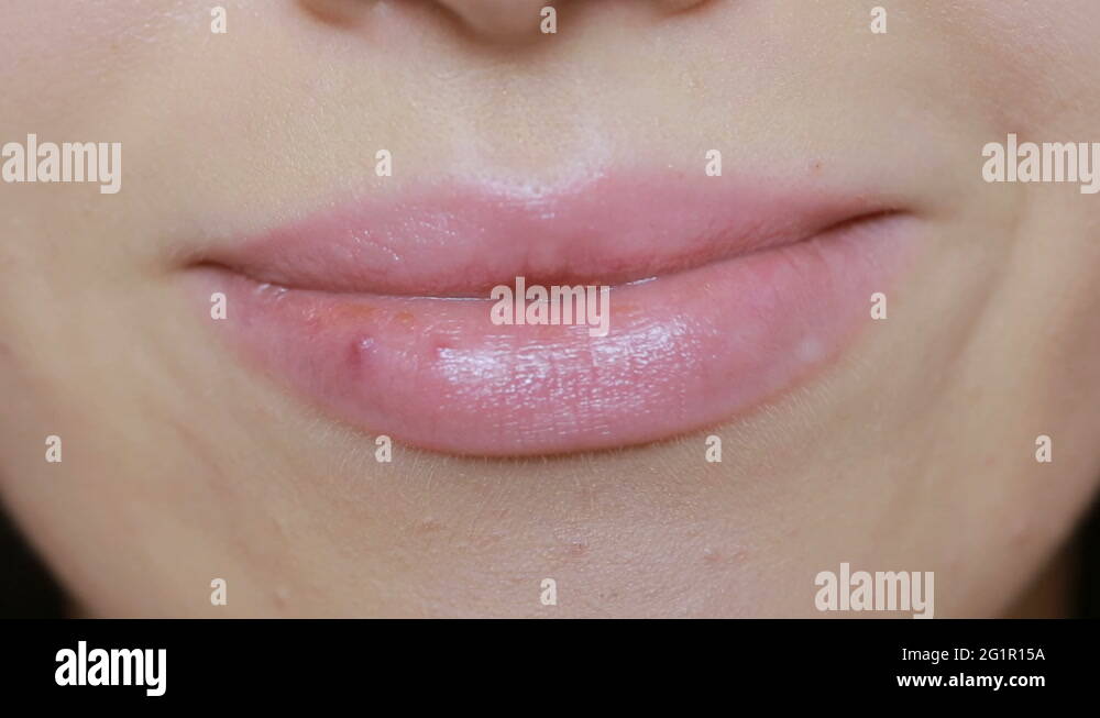girl touching sores on the lips. herpes. lip treatment, Young plump ...