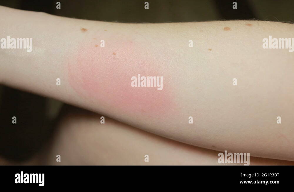 hyperemia. an allergic reaction to the body. hives. red spots on the ...