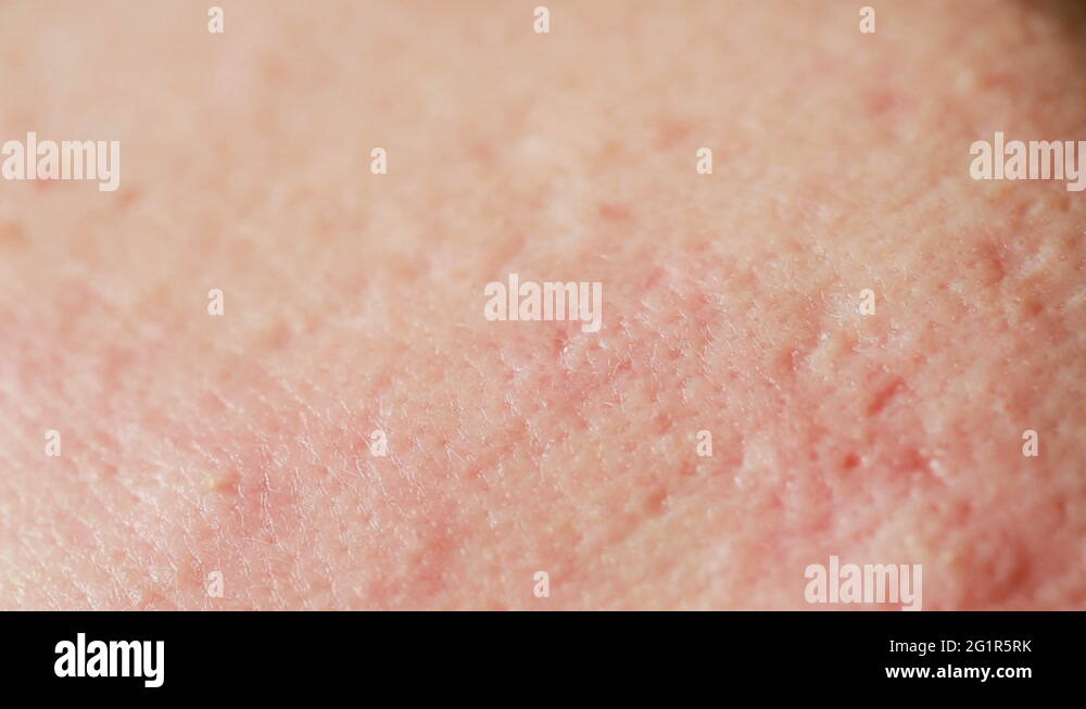 spherical cystic acne on the skin. Close-up. The concept of dermatology ...