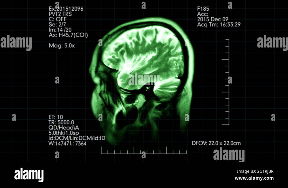 Green side view MRI brain scan display Stock Video Footage - Alamy