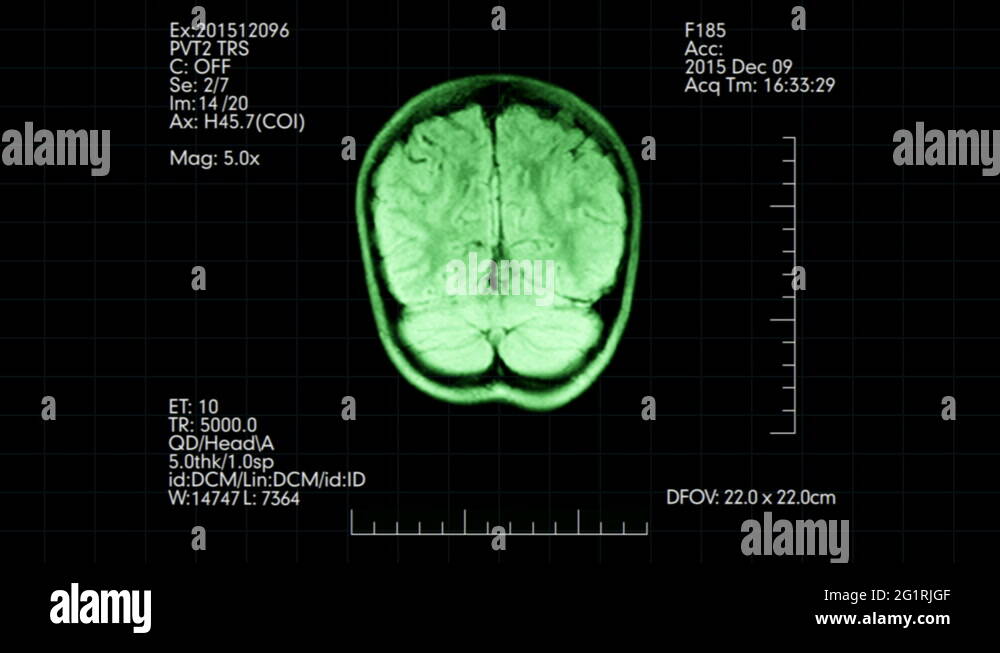 Mri scan brain colored Stock Videos & Footage - HD and 4K Video Clips ...