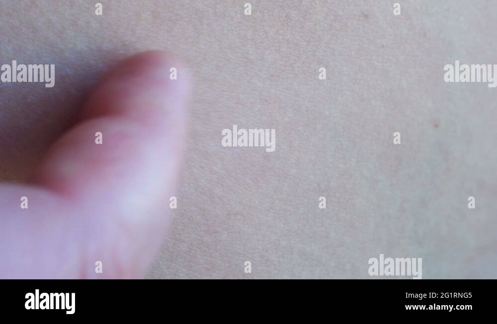 Melanoma mole on men Stock Videos & Footage - HD and 4K Video Clips - Alamy