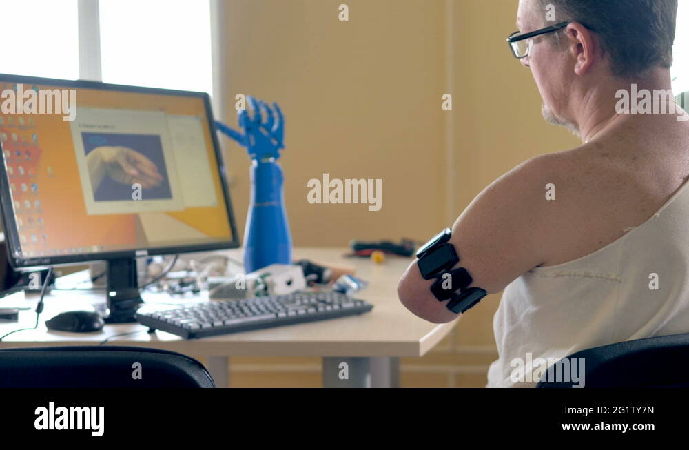 Man with the amputated arm using computer with wireless bionic sensors ...