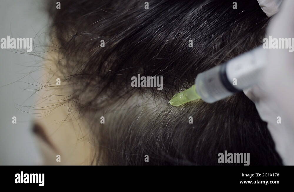 Handsome woman receiving an injection in the head mesotherapy. Thrust ...