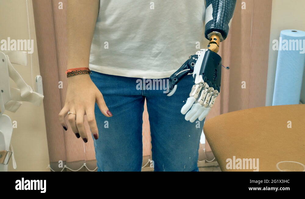 Bionic arm connected to a disabled woman hand. 4K Stock Video Footage ...