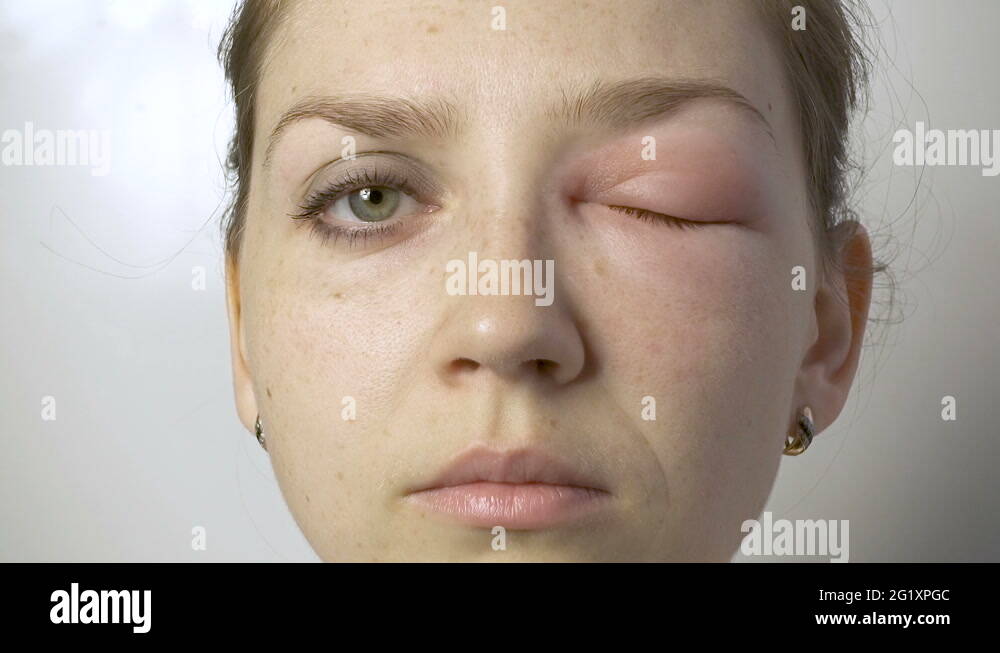 Angioneurotic edema Stock Videos & Footage - HD and 4K Video Clips - Alamy