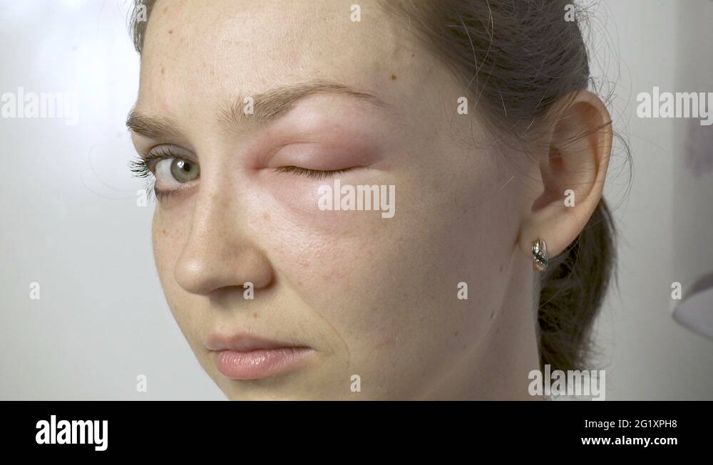 Edema eye Stock Videos & Footage - HD and 4K Video Clips - Alamy