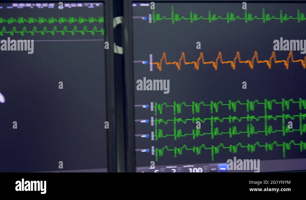 Vital parameters, ecg, cardiogram on a medical screen. Patient monitor ...