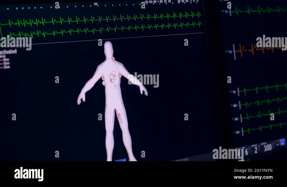Ecg, cardiogram data on display Stock Video Footage - Alamy