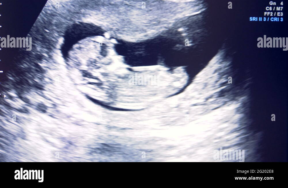 Embryo's development process displayed on a monitor during sonography ...