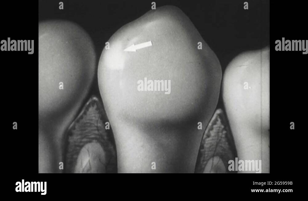 RUSSIA: 1950s: Animation of teeth. Nerves inside tooth. Surface on ...