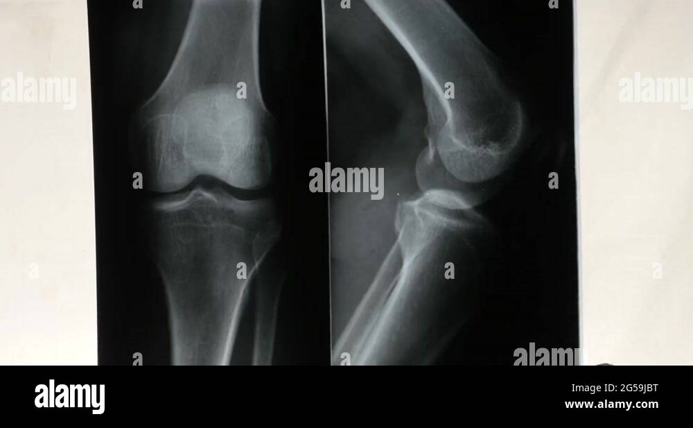 4k doctors study arm,leg joints X-ray film for analysis.medical health ...