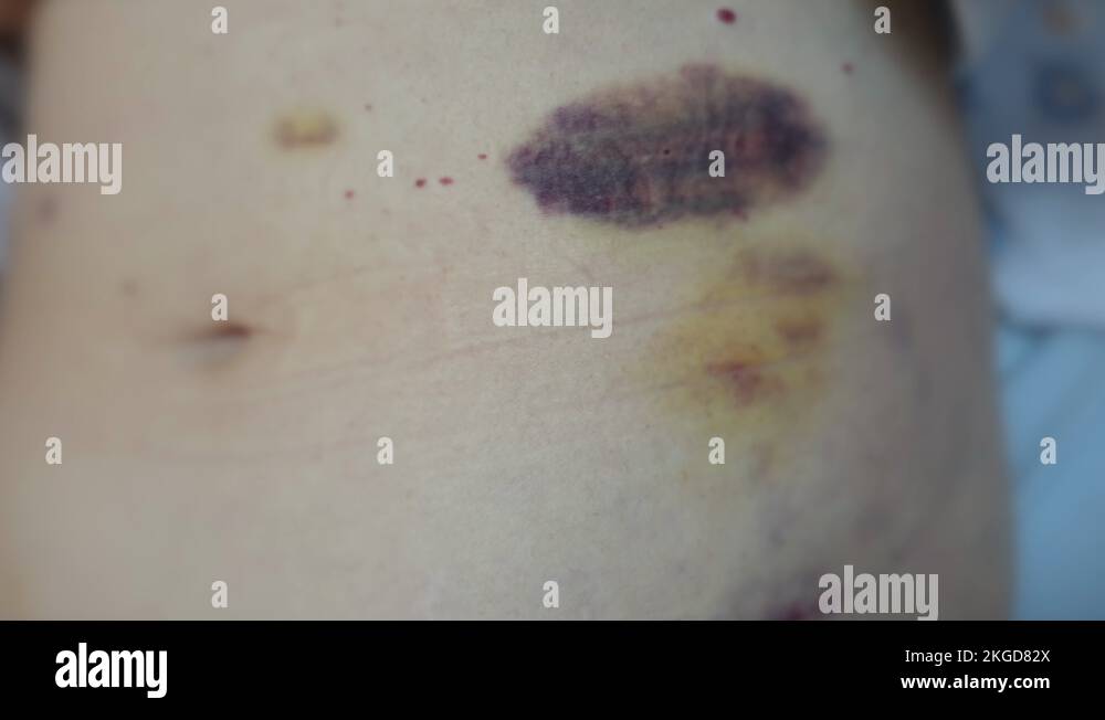 Female belly skin disease Stock Videos & Footage - HD and 4K Video ...