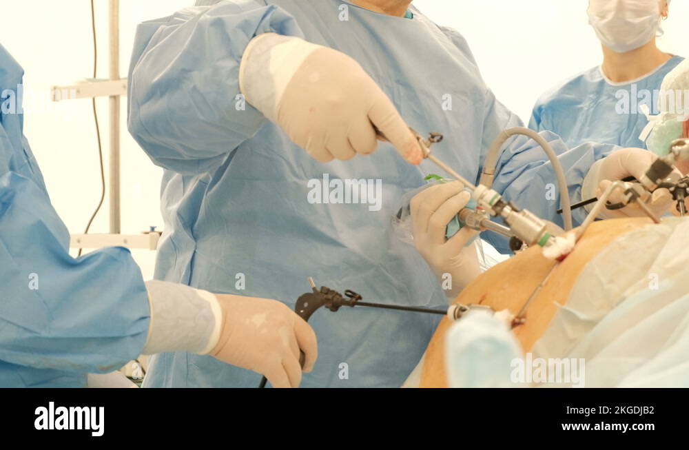 Surgical endoscopic laparoscopy. Camera movement from top to bottom ...