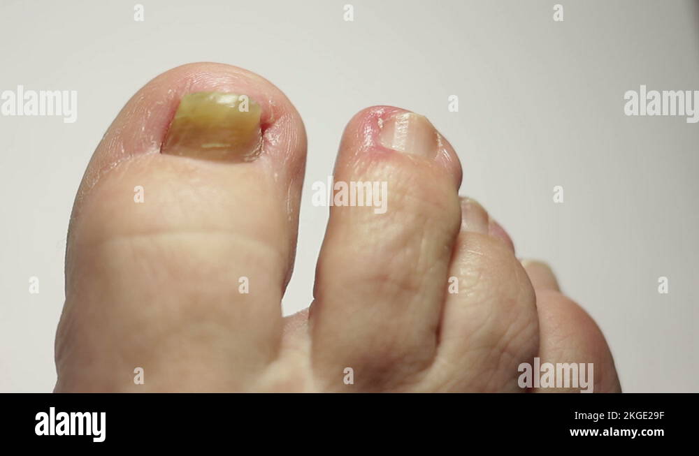 Toes of the right foot of a person with a fungal infection on the big ...