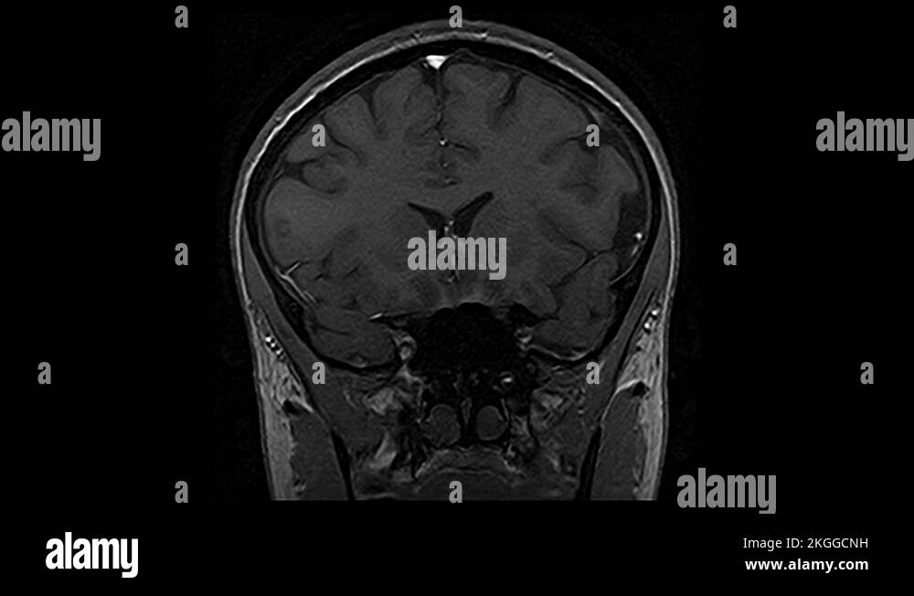 Computed Medical Tomography MRI Upscaled Scan of Healthy Young Female ...