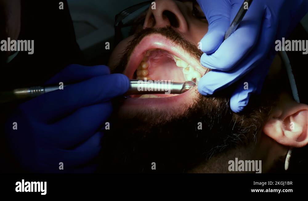Dentist is drilling man tooth to fill a tooth Stock Video Footage - Alamy