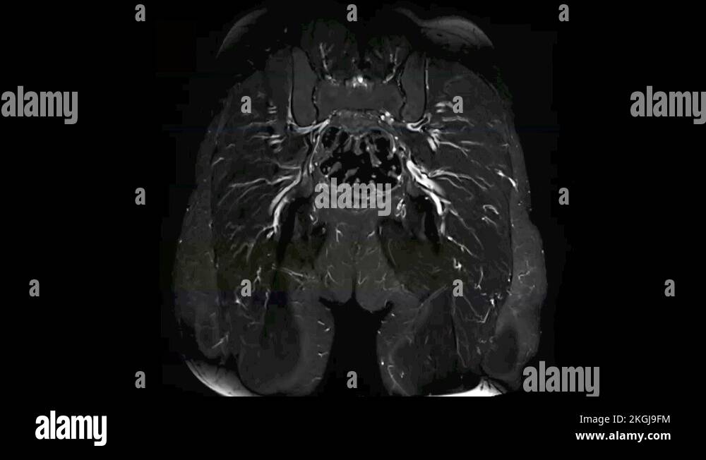 Osteonecrosis of the hips, MRI scan Stock Video Footage - Alamy
