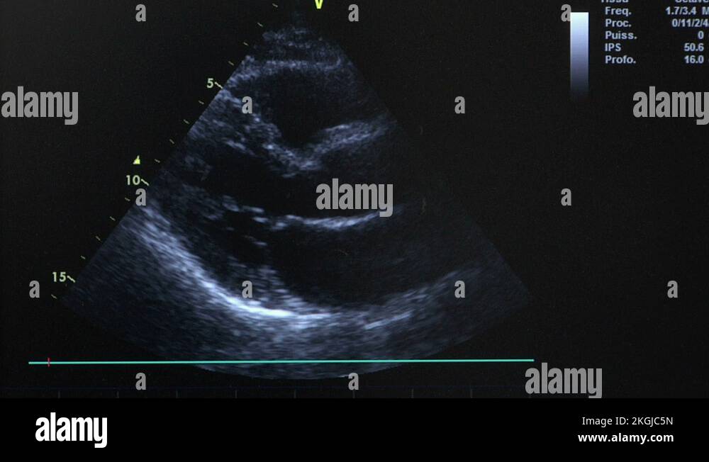 Doppler ultrasound Stock Videos & Footage - HD and 4K Video Clips - Alamy