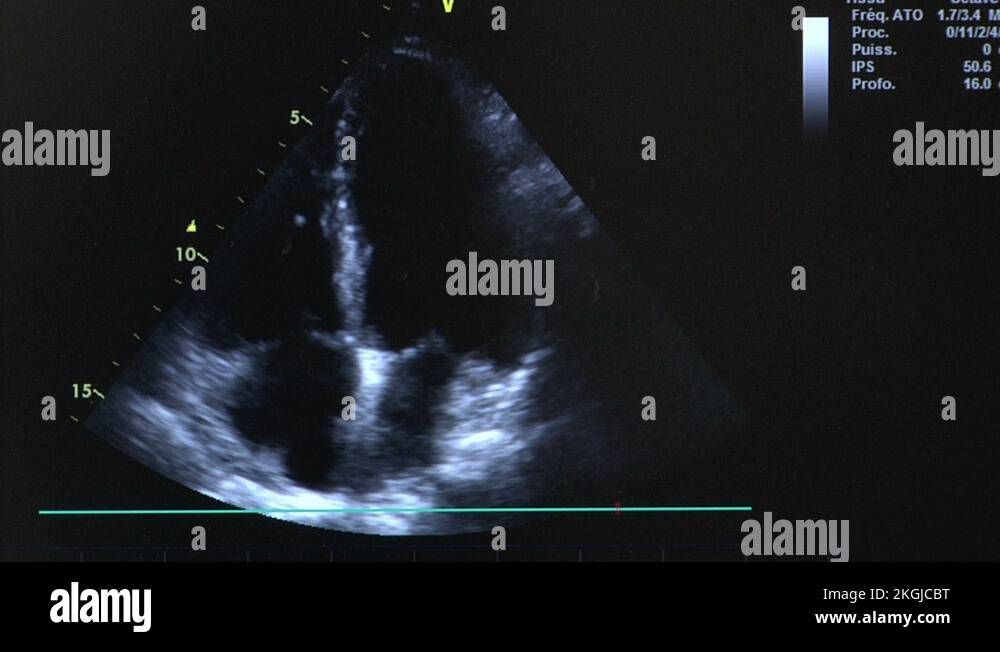 Echocardiogram Stock Videos & Footage - HD and 4K Video Clips - Alamy