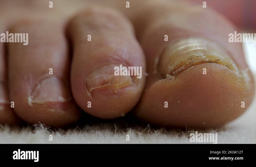 Toenail trauma Stock Videos & Footage - HD and 4K Video Clips - Alamy