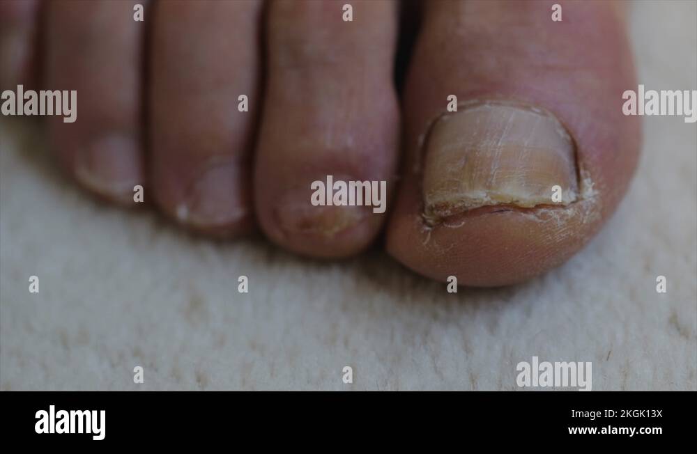 Man toe medical Stock Videos & Footage - HD and 4K Video Clips - Alamy