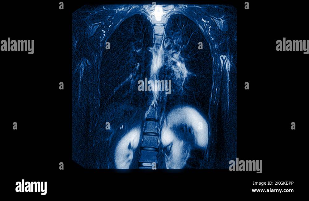 Computed Medical Tomography MRI Upscaled Scan of Healthy Young Female ...