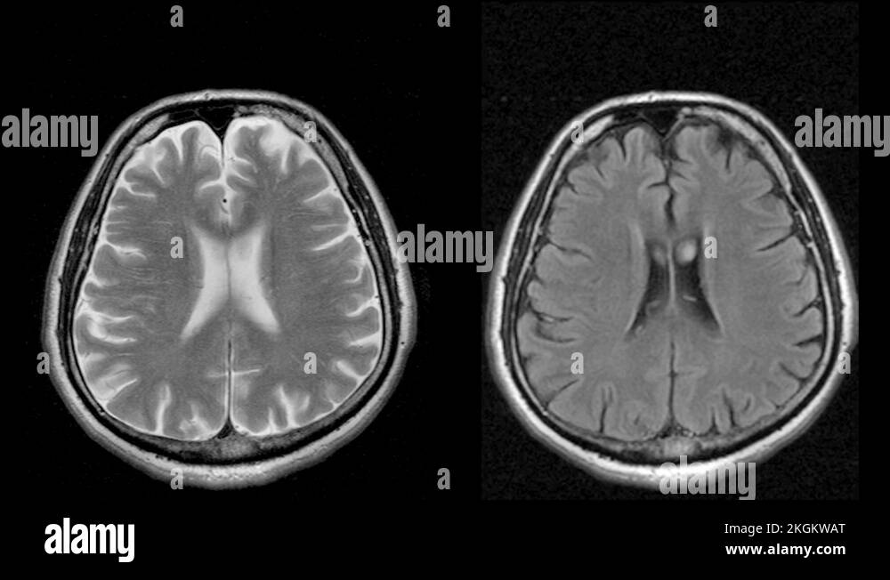Magnetic resonance scan of the headache in two different ways, MRI ...