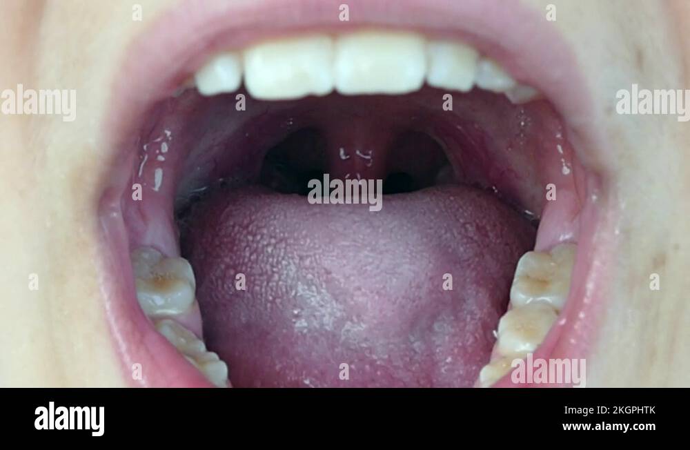 Pharyngeal tonsils Stock Videos & Footage - HD and 4K Video Clips - Alamy