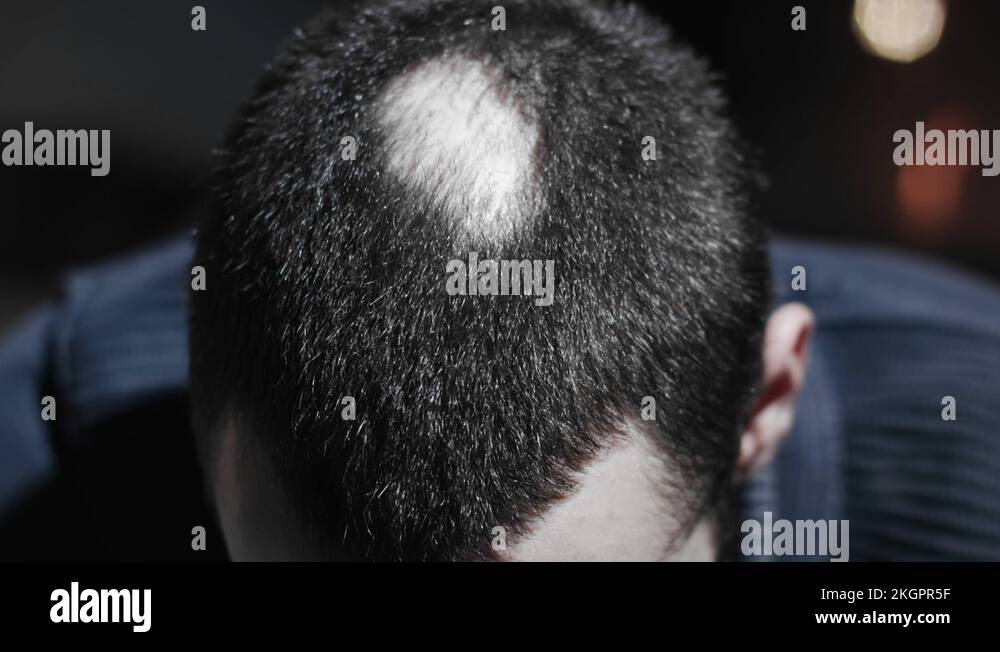 Alopecia medical Stock Videos & Footage - HD and 4K Video Clips - Alamy