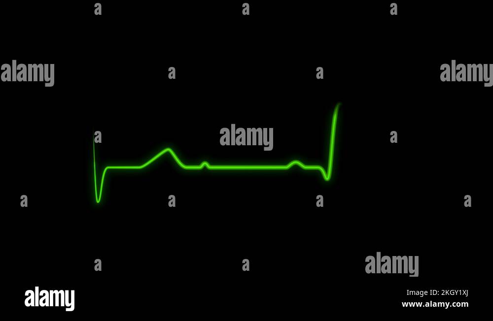 Electrocardiogram graph ekg heart rhythm Stock Videos & Footage - HD ...