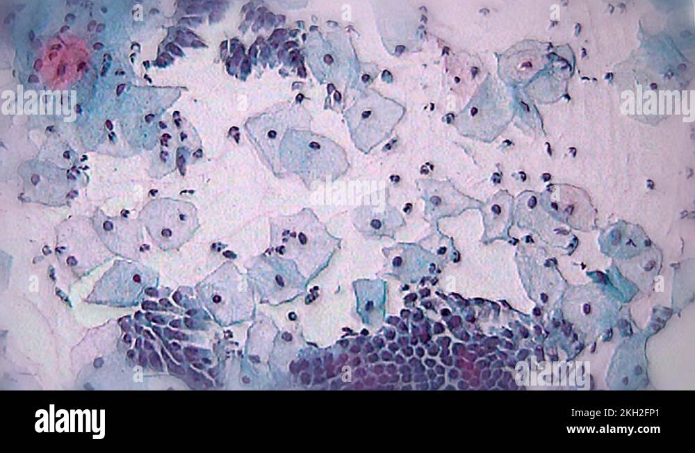 Pap smear malignant cells Stock Videos & Footage - HD and 4K Video ...