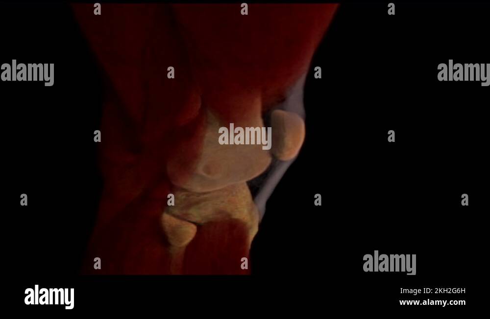 Interphalangeal joints osteoarthritis Stock Videos & Footage - HD and ...