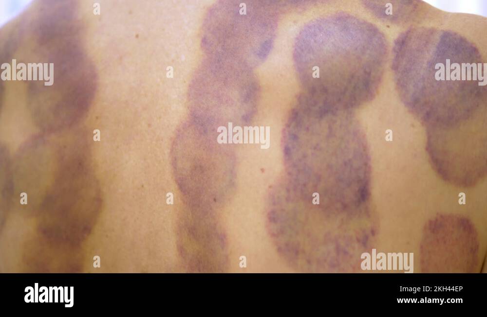 Round bruises. Traces on the back of a young woman after the procedure ...