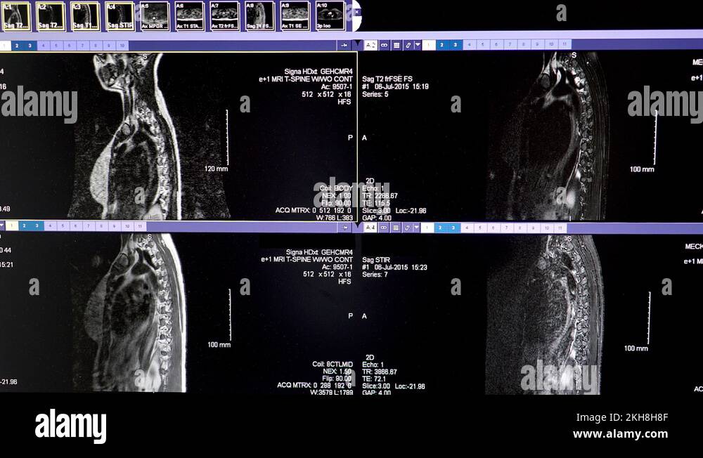 Thoracic mri Stock Videos & Footage - HD and 4K Video Clips - Alamy