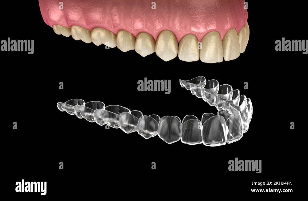 Invisible plastic teeth aligner Stock Videos & Footage - HD and 4K ...