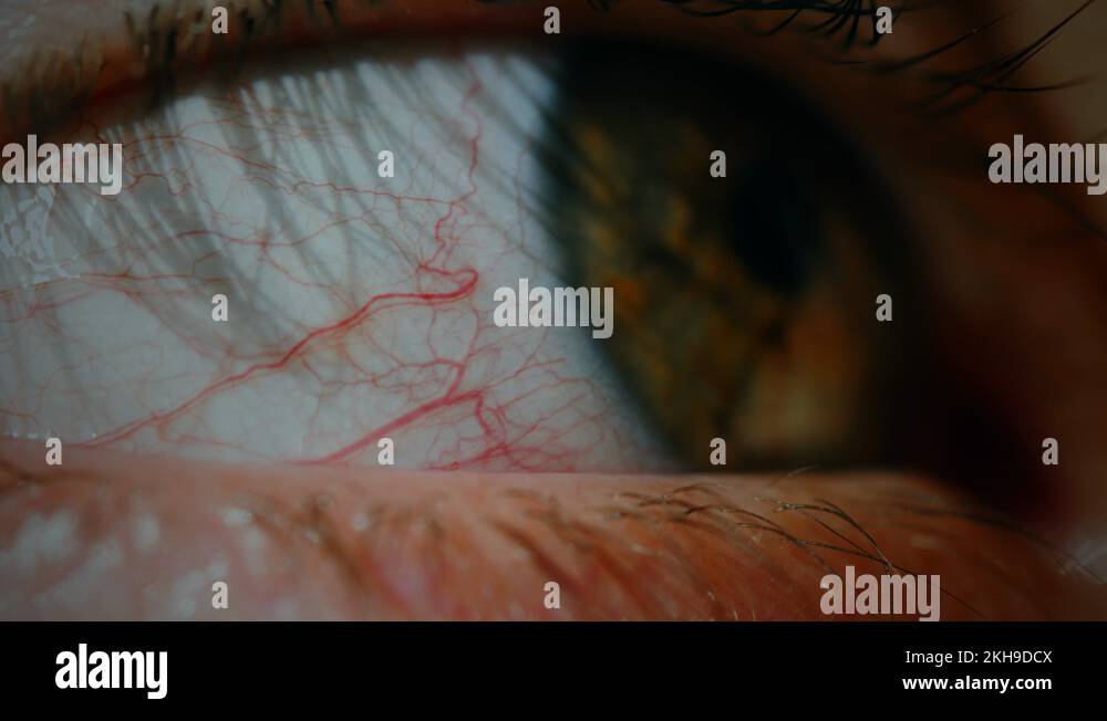 Conjunctivitis veins Stock Videos & Footage - HD and 4K Video Clips - Alamy