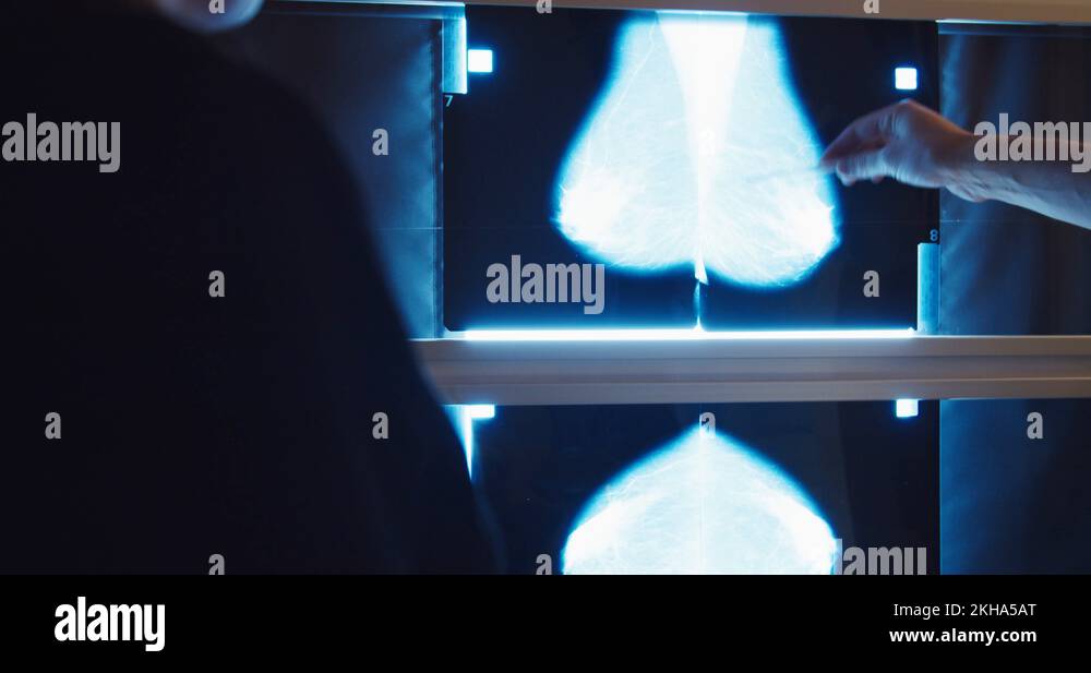 Mammography Stock Videos & Footage - HD and 4K Video Clips - Alamy