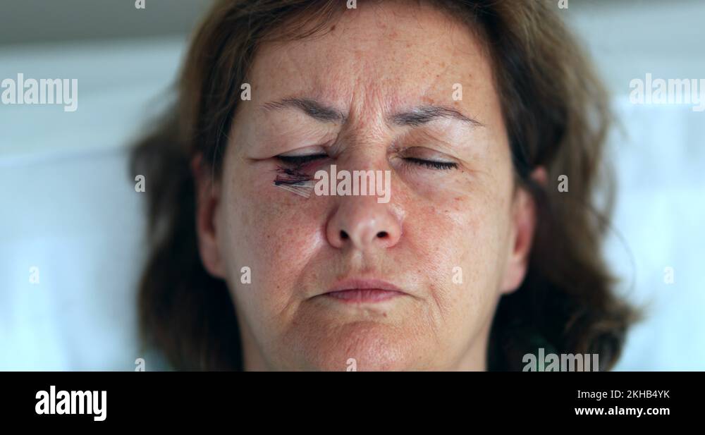 Basal cell carcinoma scar Stock Videos & Footage - HD and 4K Video ...