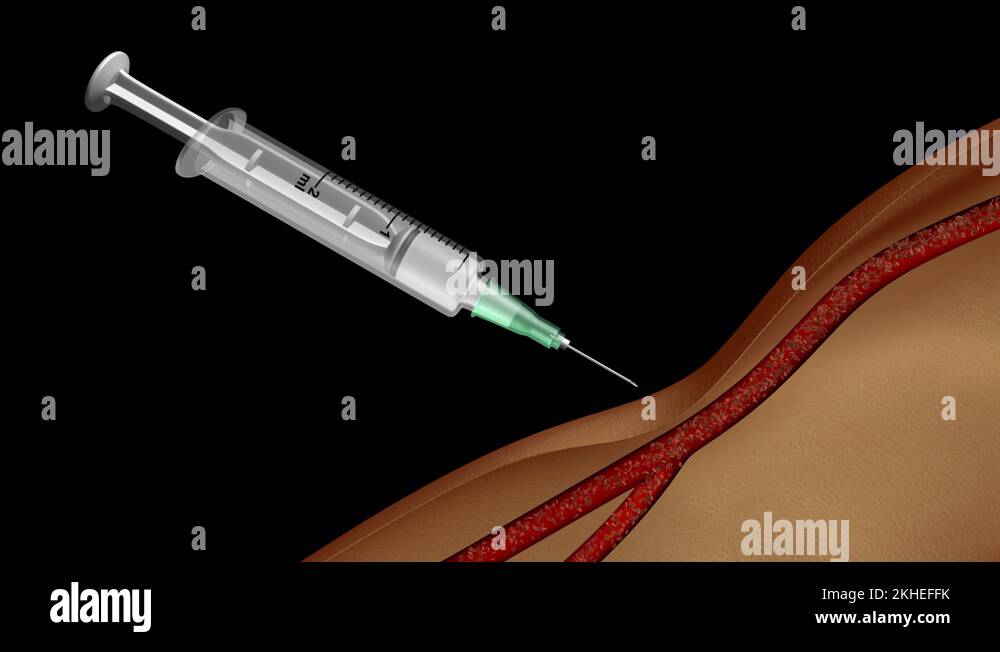 Injecting arm hypodermic Stock Videos & Footage - HD and 4K Video Clips ...