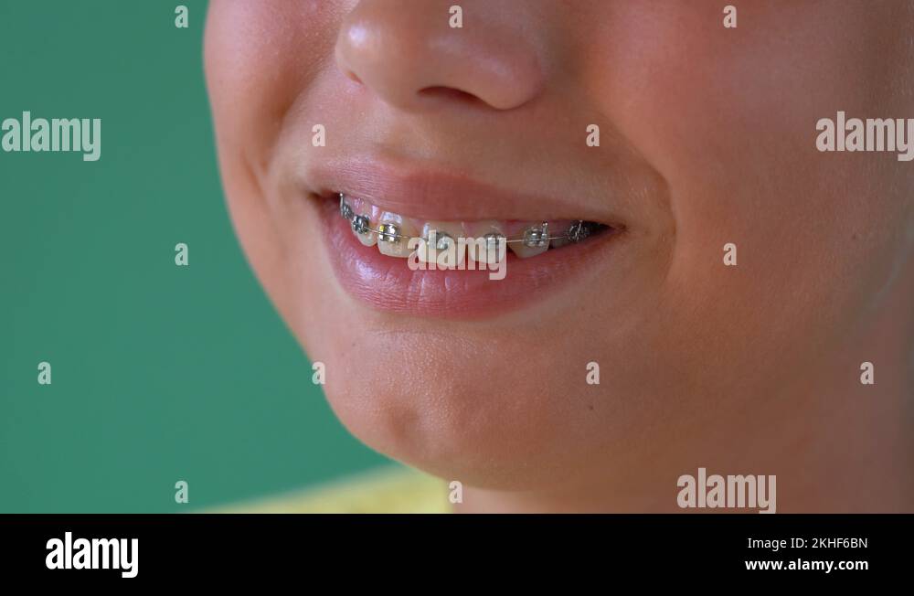 Green braces Stock Videos & Footage - HD and 4K Video Clips - Alamy