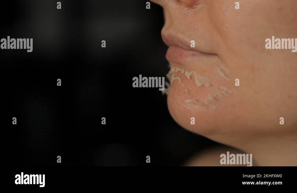 Peeling skin on the face. Woman's face after chemical peeling ...