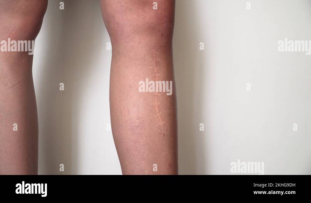 Leg bone fracture Stock Videos & Footage - HD and 4K Video Clips - Alamy