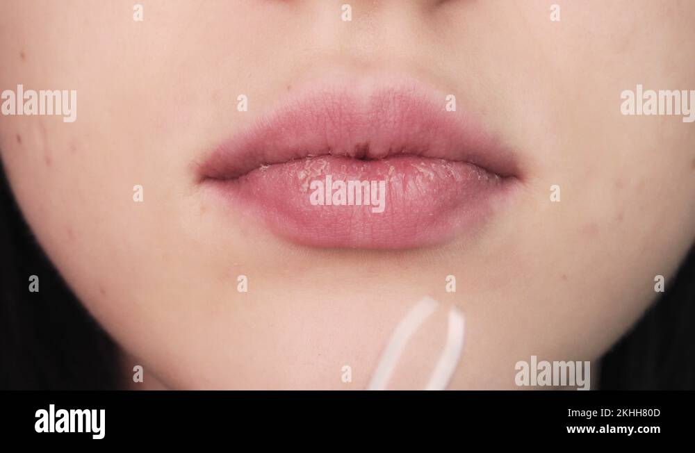 Girl smears ointment lips. Dry skin in the cold season Stock Video ...