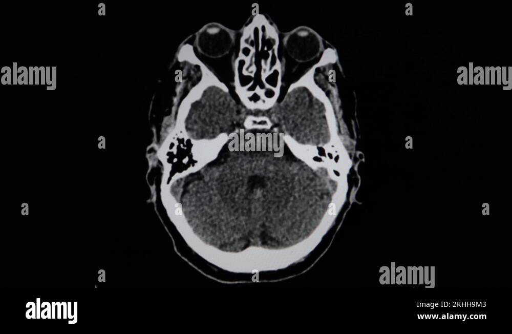MRI of head / brain, CT scan axial footage Stock Video Footage - Alamy